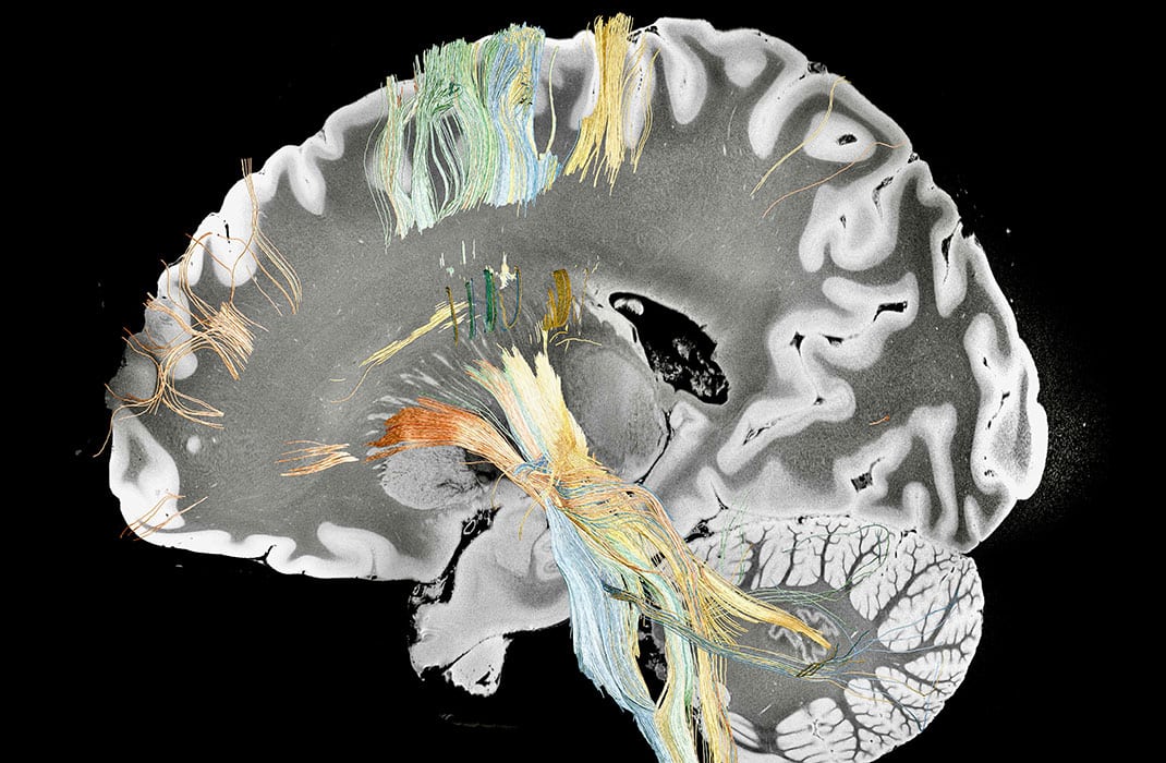 For Deep Brain Stimulation, Better Mapping of the Brain Yields Greater ...